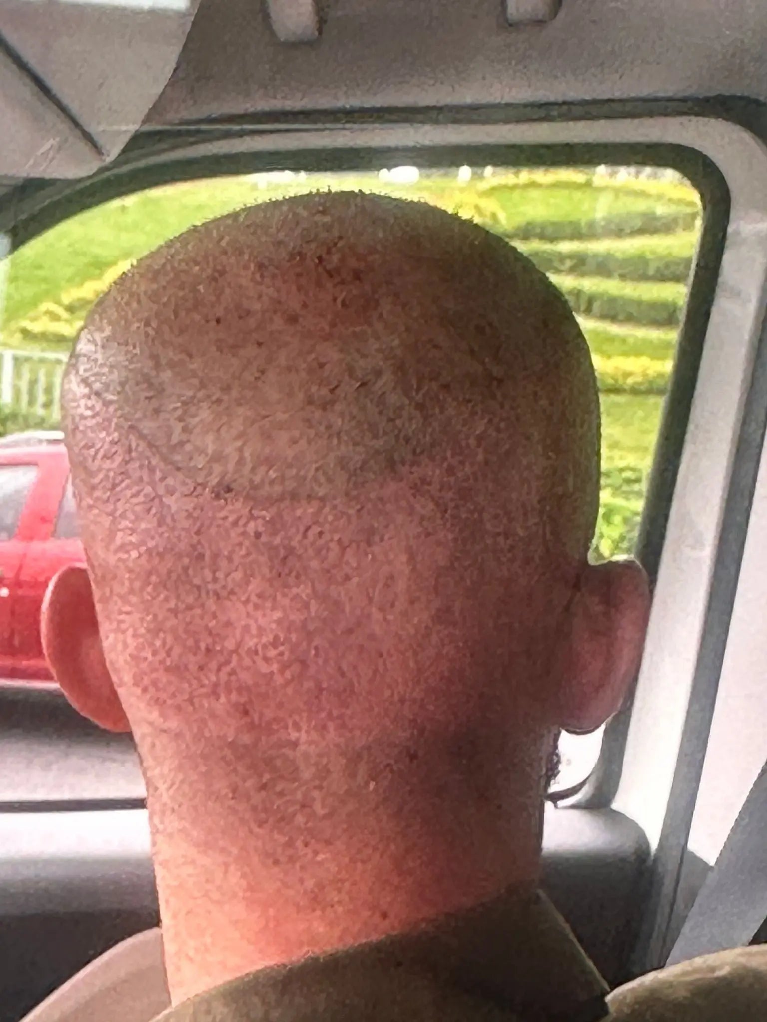 The Benefits of SMP After a Hair Transplant: What You Need to Know ...