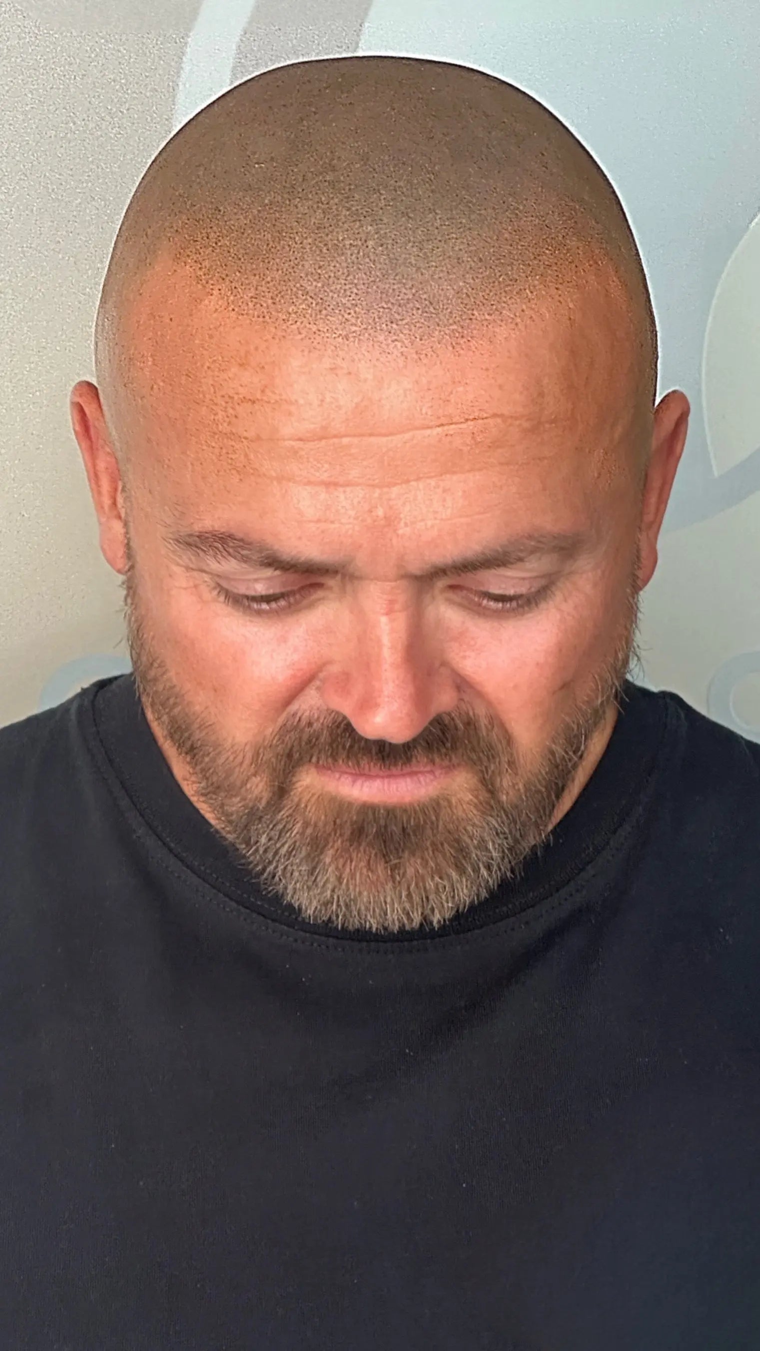 Mastering Hairline Design in Scalp Micropigmentation: Tips and – MicroHair